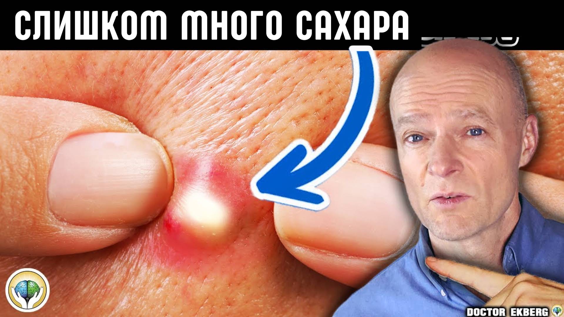 10 признаков того что вы едите слишком много сахара Dr. Sten Ekberg