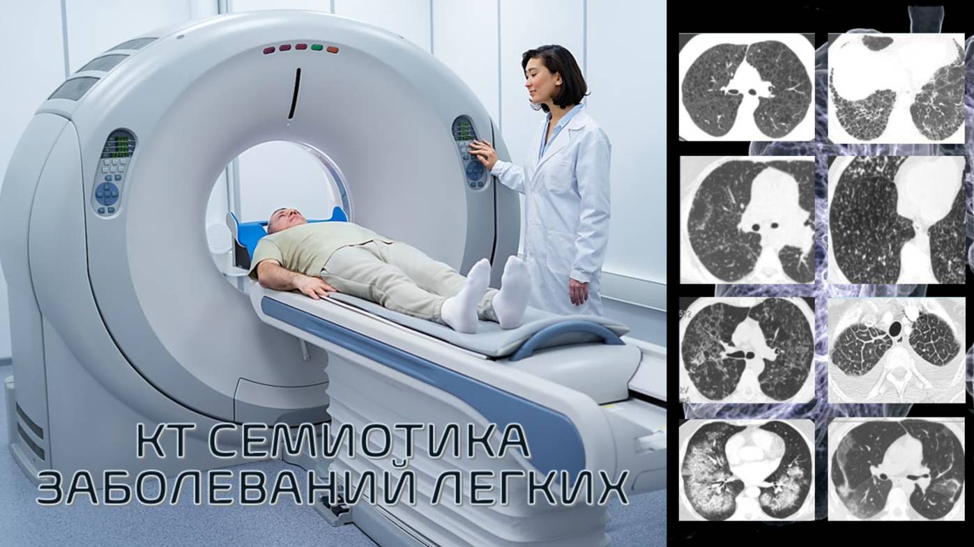 КТ-СЕМИОТИКА ЗАБОЛЕВАНИЙ ЛЕГКИХ