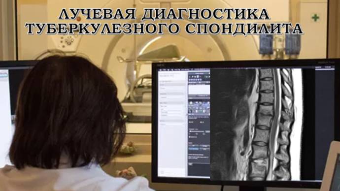Лучевая диагностика туберкулезного спондилита.