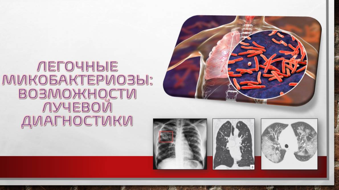 ЛЕГОЧНЫЕ МИКОБАКТЕРИОЗЫ - ВОЗМОЖНОСТИ ЛУЧЕВОЙ ДИАГНОСТИКИ