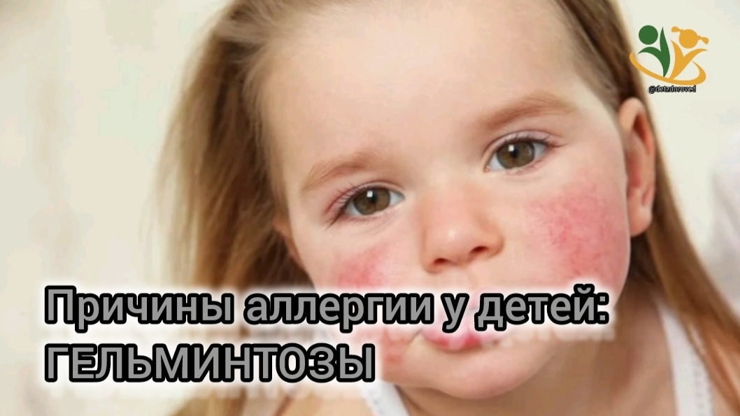 💥Причины аллергии у детей: гельминтоз. О.А.Бутакова