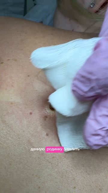 Что делать, если травмировали родинку?