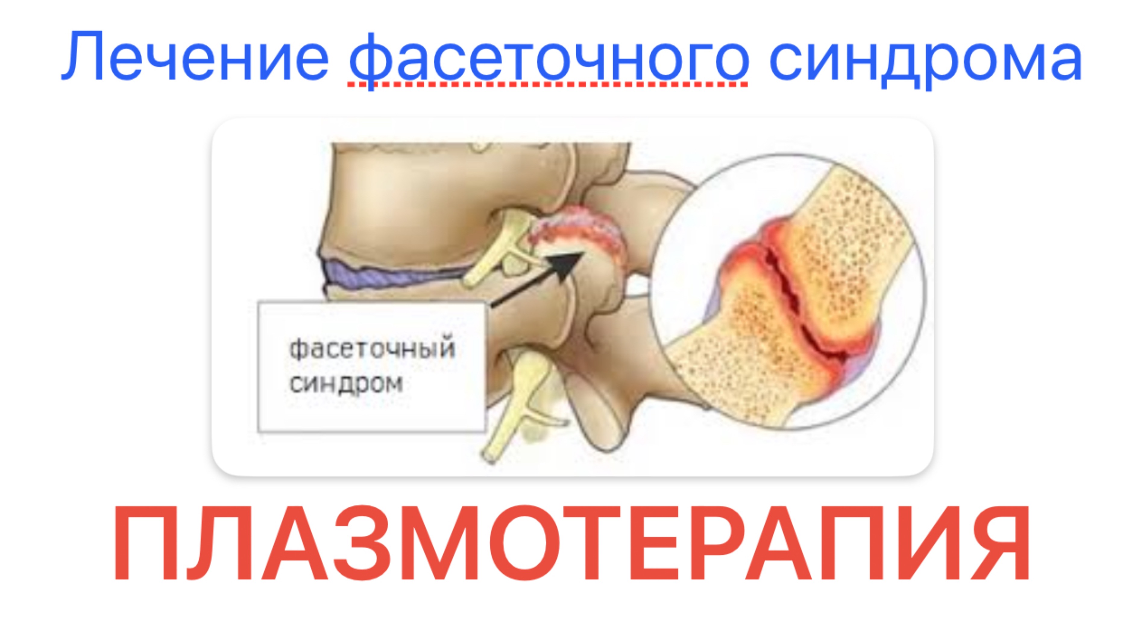Плазмотерапия при фасеточном синдроме. Лечим поясницу в НейроКлиник в Митино