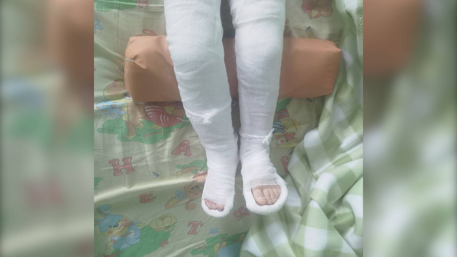 Трехлетний ребенок сломал ноги на новой спортплощадке в Бурятии
