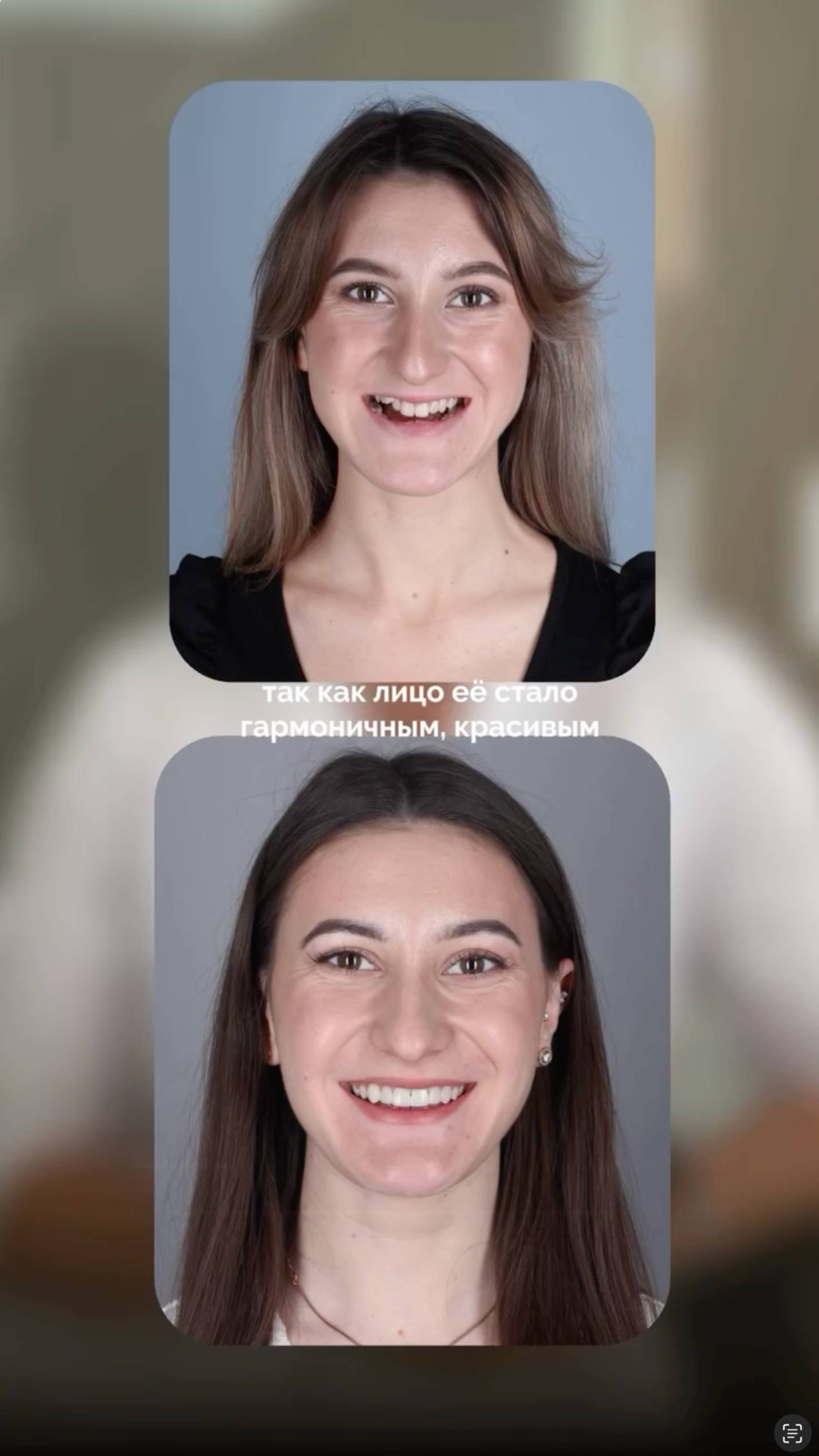 Коррекция прикуса и реставрация зубов. Как мы исправляли челюстно-лицевую патологию пациентке 18лет