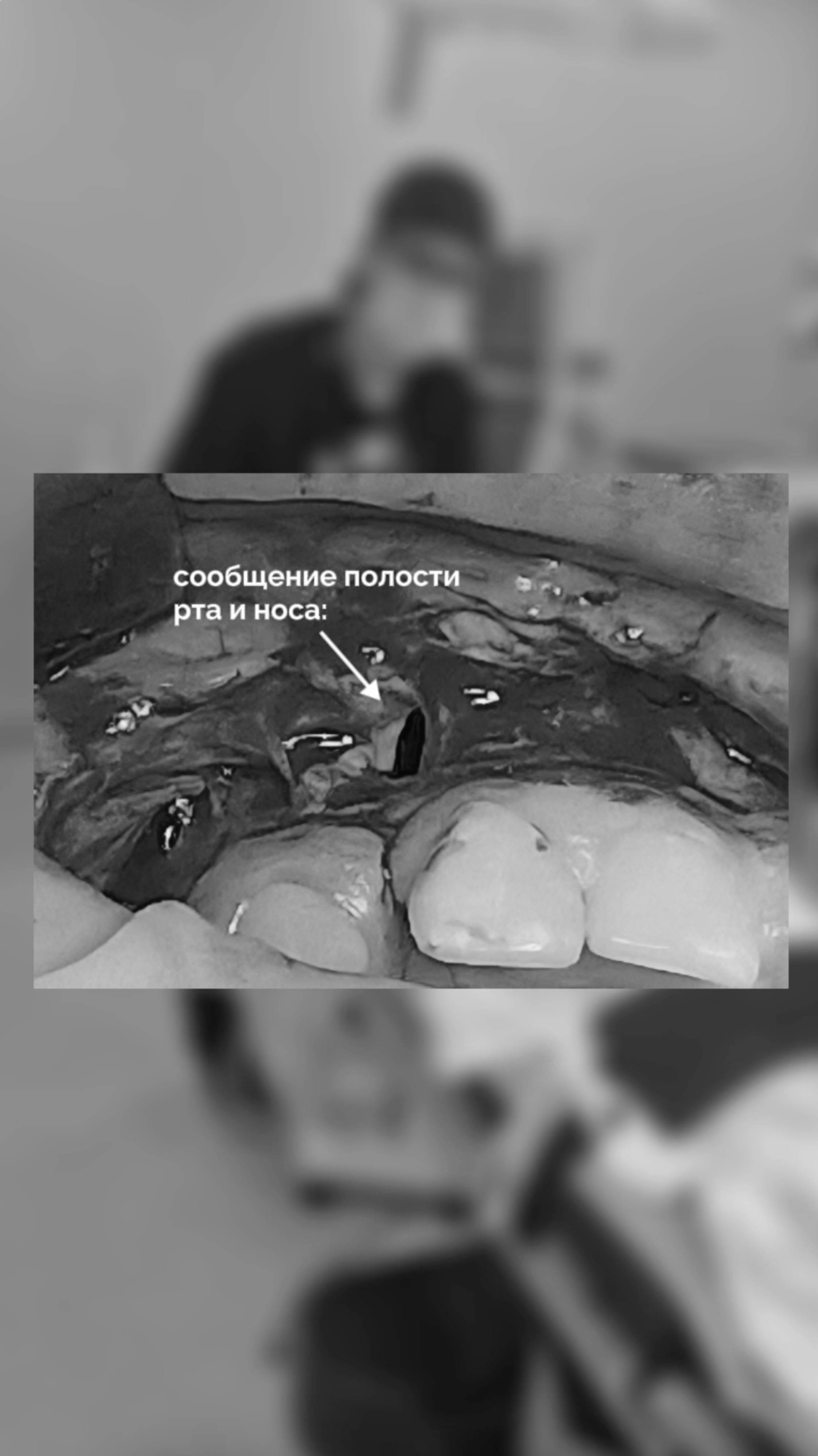 Работа в областной детской больнице: устраняем дефект - расщелину между носом и ртом  #shots