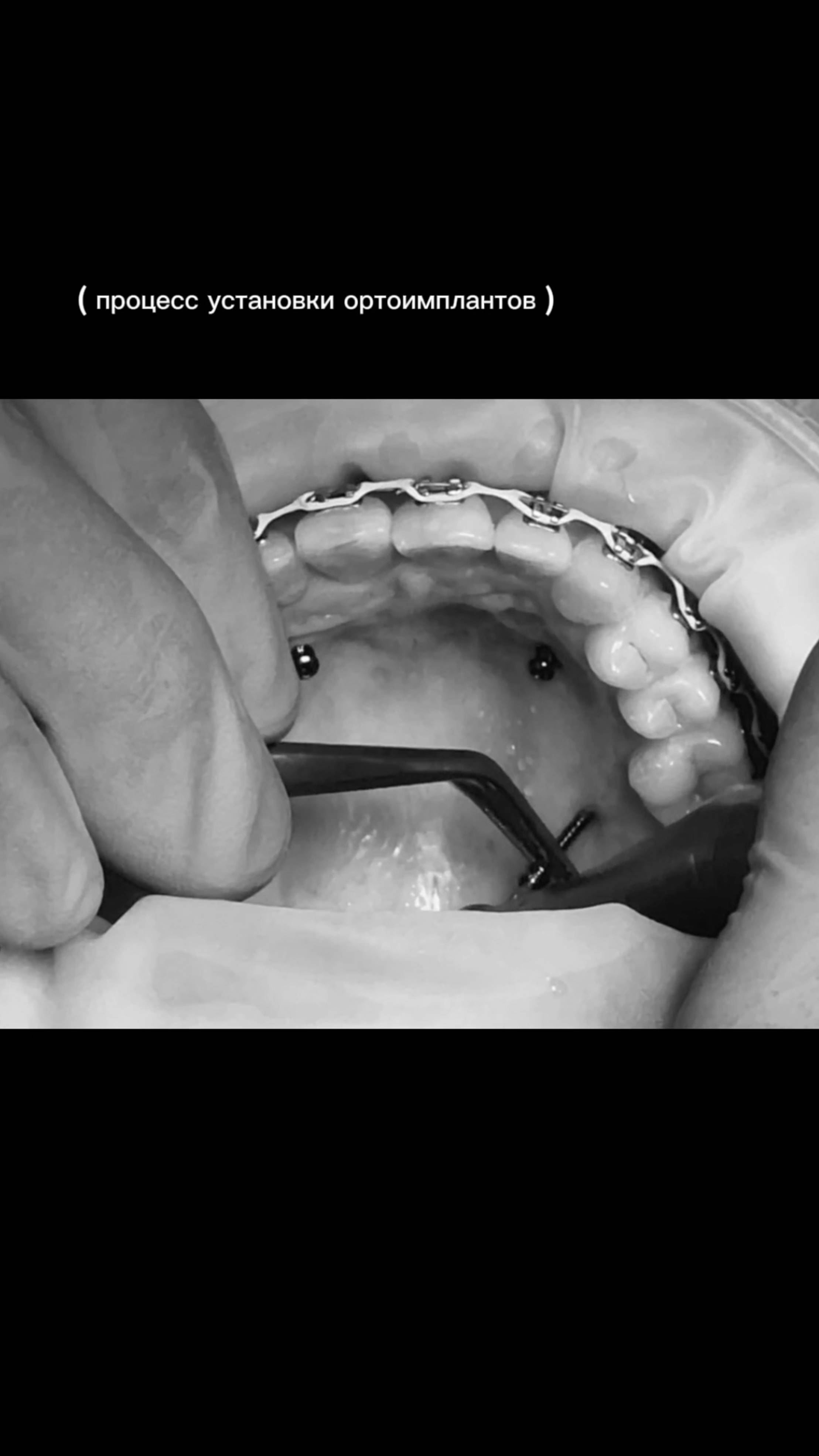 Ортоимпланты - что это такое и для чего нужны? #shots