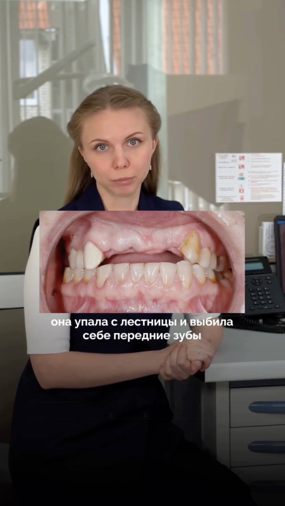 Передние верхние зубы выбиты из-за падения 😱 #shots