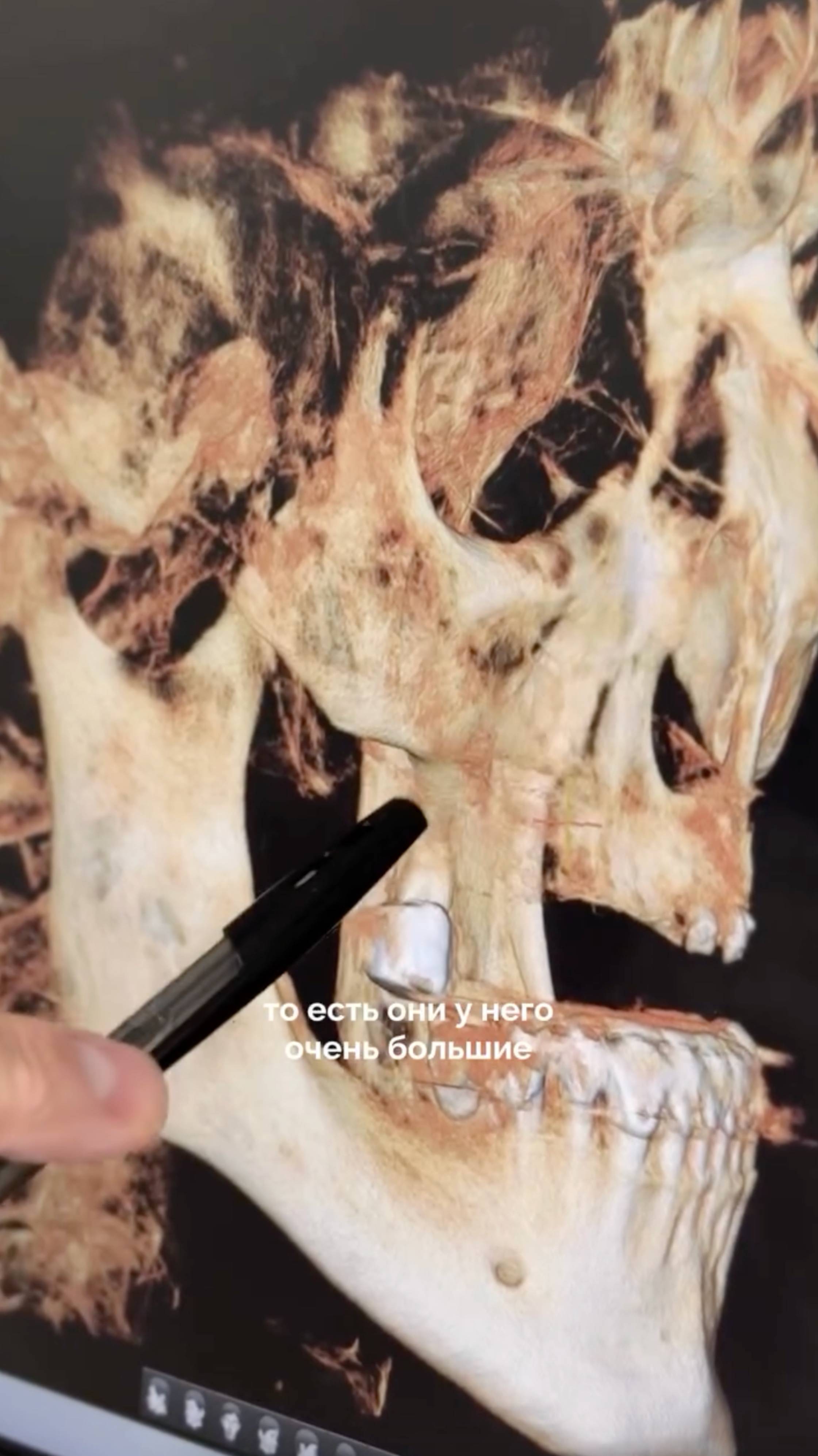 Что такое открытый синус-лифтинг? И как лучше установить импланты, если нет кости