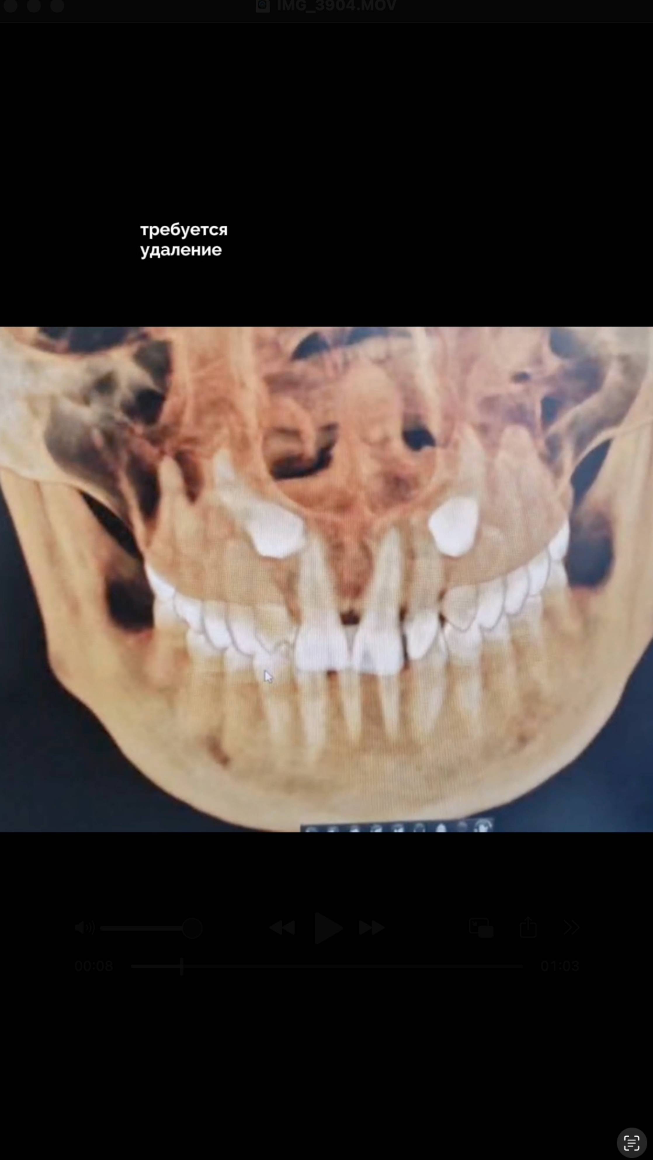 Лишними могут быть не только зубы мудрости #shots