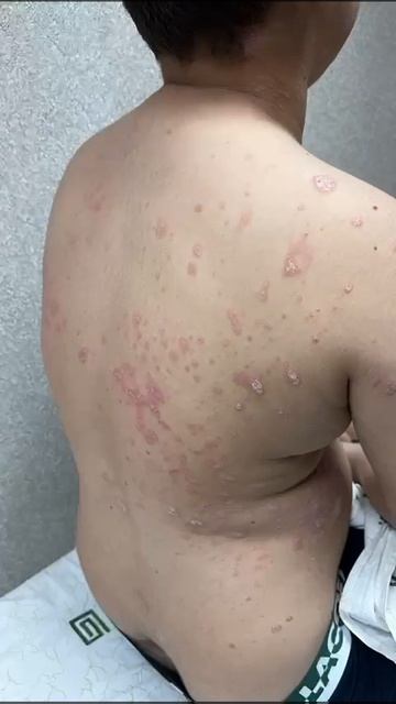 ПСОРИАЗ ИЗЛЕЧИМ / УНИКАЛЬНАЯ ПРОДУКЦИЯ КОМПАНИИ  WHIEDA  ДЛЯ ЗДОРОВЬЯ И ОМОЛОЖЕНИЯ