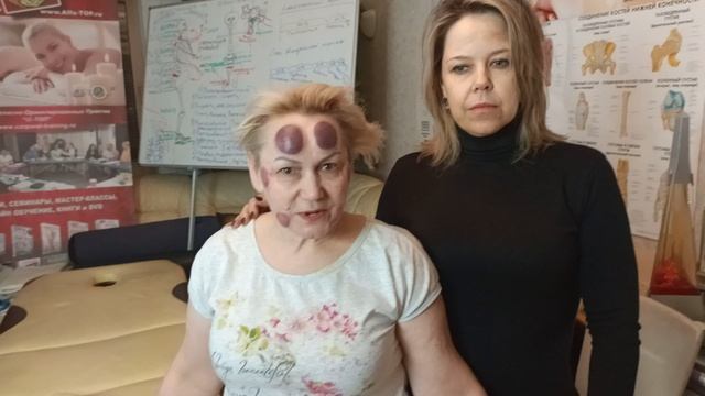 После процедуры Косметическая Хиджама сразу стало легче. (Отзыв) Хаджам-мастер Олег-Олаф Гудвин.