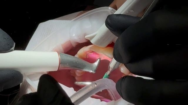 GBT протокол в стоматологической клинике «Премиум Орто»