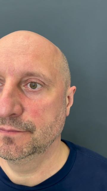 #мужская_блефаропластика: до и после