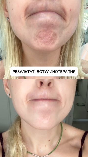 Ботулинотерапия подбородка препаратом Xeomin: до и после