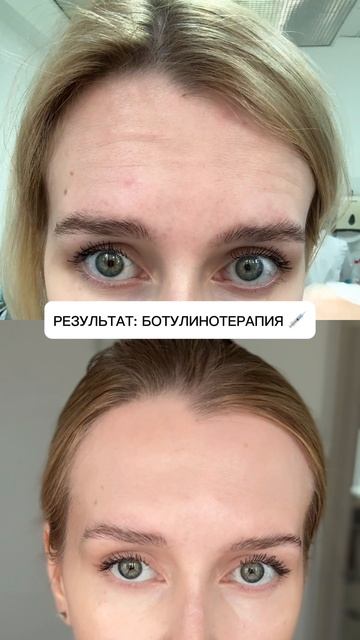 Ботулинотерапия лба препаратом Xeomin: до и после