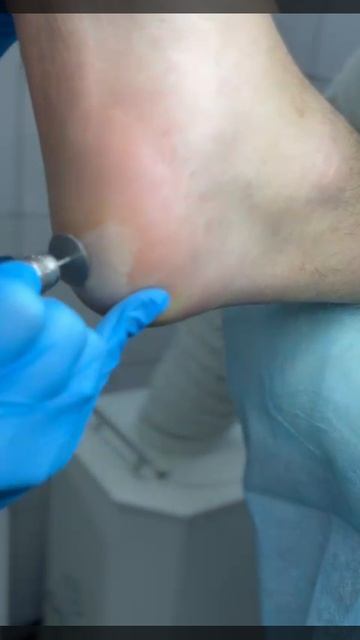 Медицинский педикюр