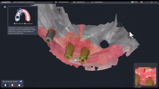 Сканирование Сканбоди  и сопоставление со сканом  слизистой