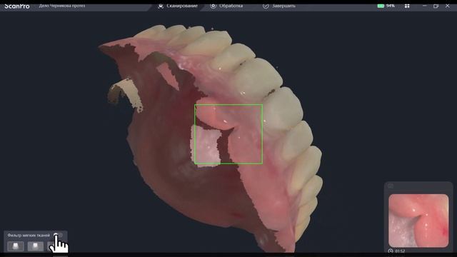 Сканирование полного съемного  протеза на верхней  челюсти