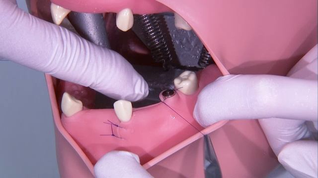 Упражнения на имплантах (23 часть, закрытие раны)