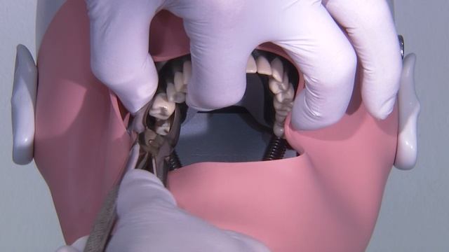 Удаление зуба (6 часть, вывих, удаление зуба щипцами)