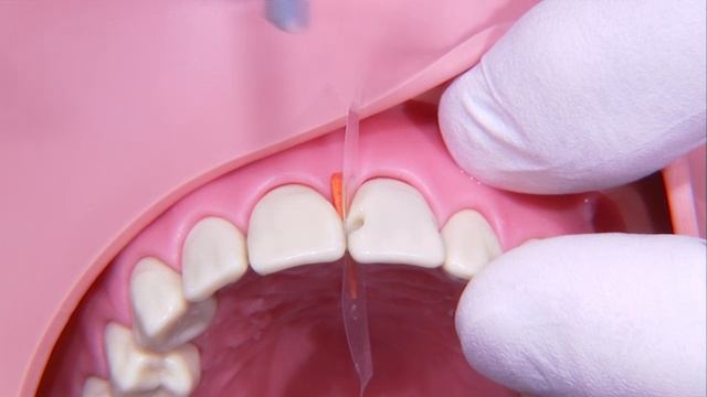 Реставрация передних зубов (9 часть, склеивание)