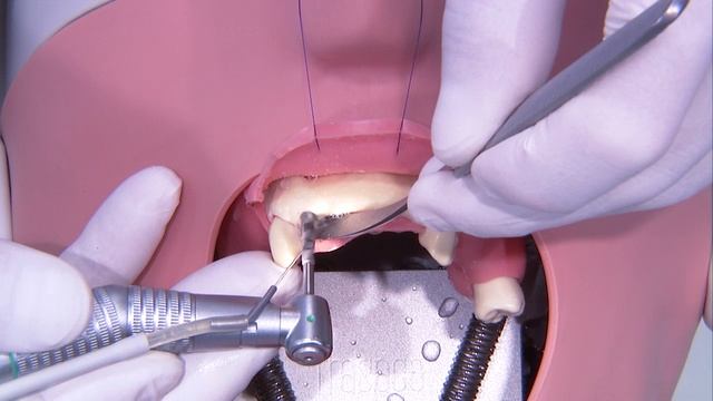 Имплантология (8 часть, пилотный участок 2)