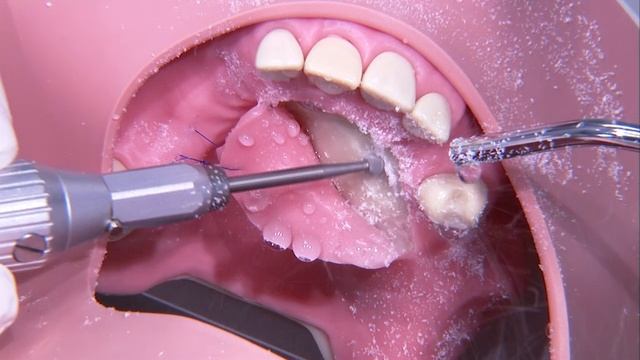 Оперативное удаление ретенированного клыка (4 часть, остеотомия с использованием шаровидного бора)