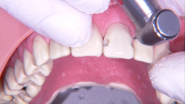 Реставрация передних зубов (4 часть, скос на эмали)