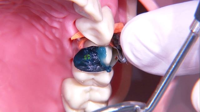 Восстановление культи зуба (12 часть, кислотное травление)