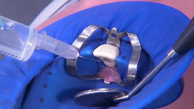 Эндодонтия (6 часть, промывание корневого канала)