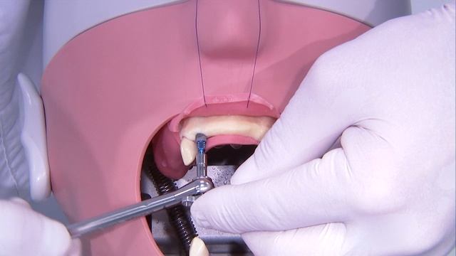 Имплантология (17 часть, установка импланта в область 12 зубов)