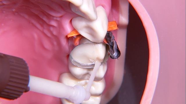 Восстановление культи зуба (14 часть, нанесение композита и полимеризация)