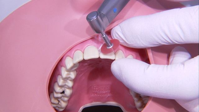 Реставрация передних зубов (13 часть, удаление излишков материала, контуринг заполнения)