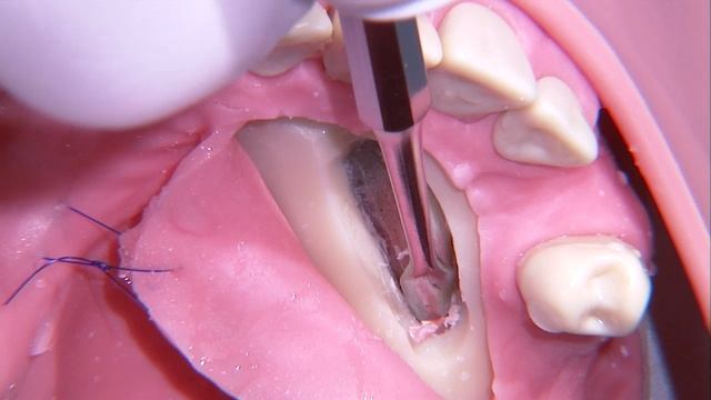 Оперативное удаление ретенированного клыка (6 часть, синдесмотомия)