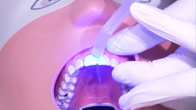Реставрация передних зубов (10 часть, светоотверждение)