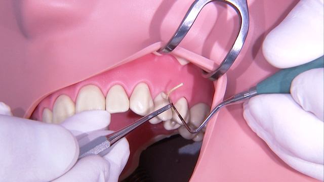 Восстановление шейки зуба (4 часть, установка ретракционных нитей)