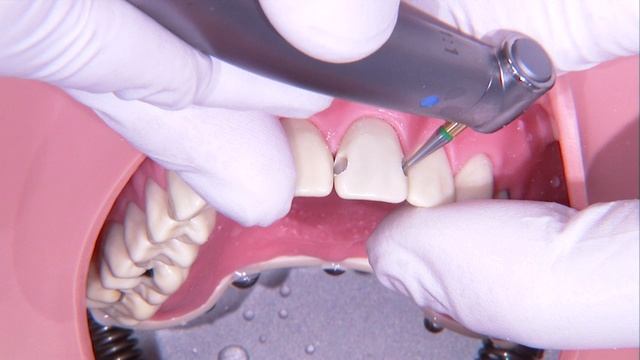 Реставрация передних зубов (3 часть, окончательная подготовка без использования воды)