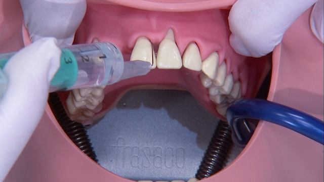 Удаление зубного камня (4 часть, заключительное промывание кармана антисептиками)