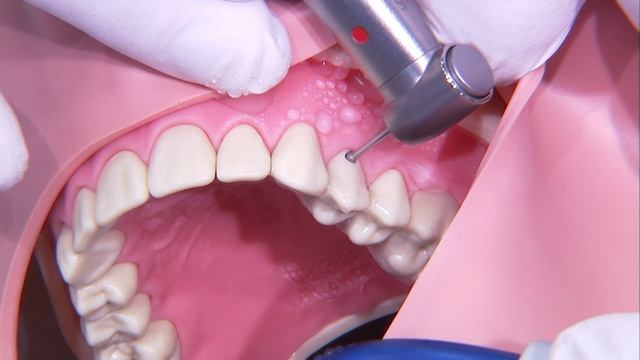 Восстановление шейки зуба (1 часть, лечение кариеса, щёчного)