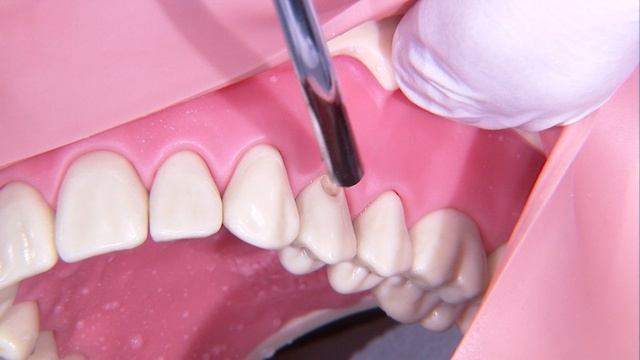 Восстановление шейки зуба (6 часть, склеивание и полимеризация)
