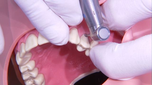 Восстановление шейки зуба (2 часть, удаление кариеса)