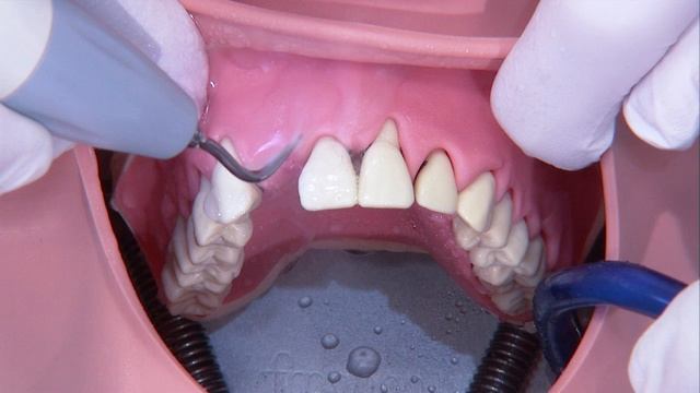 Удаление зубного камня (2 часть, ультразвуковая чистка зубов)