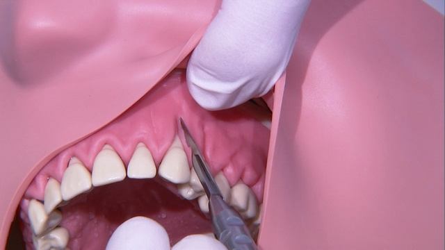 Пластическая хирургия пародонта (4 часть, разрез)