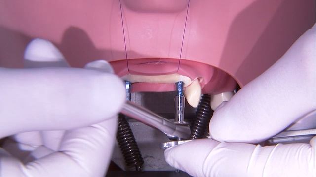 Имплантология (18 часть, установка имплантата в область 22)