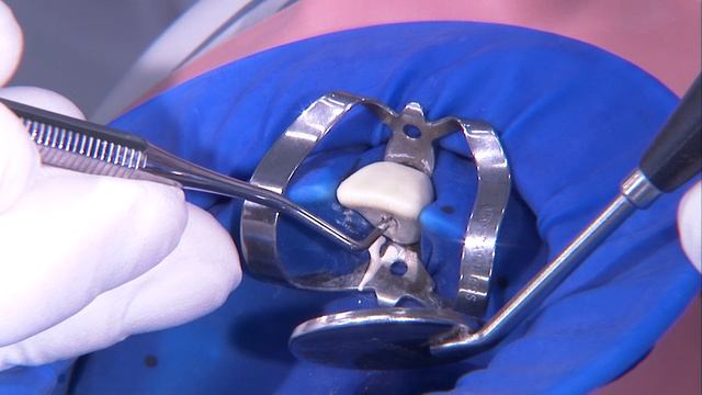 Эндодонтия (12 часть, компрессионные гуттаперчевые штифты)