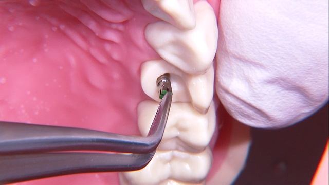 Восстановление культи зуба (4 часть, примерка корневого столба)