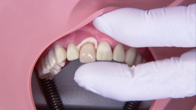 Изготовление временной коронки (7 часть, перебазировка полосовой коронки)