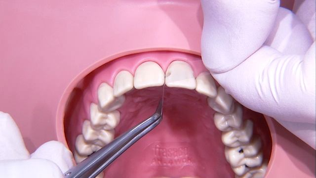 Реставрация передних зубов (6 часть, размещение матриц)