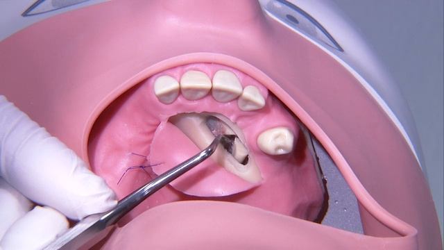 Оперативное удаление ретенированного клыка (11 часть, вывих фрагментов зуба)